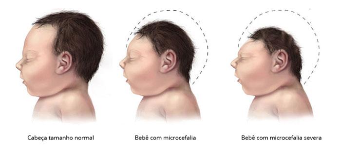 Saúde incorpora novo medicamento para pacientes com Microcefalia - V9 ...